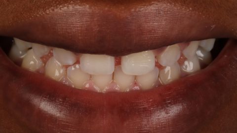 Composite Edge Bonding London | Composite Bonding Reviews