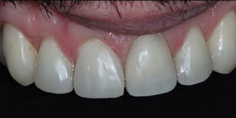 Composite Edge Bonding London | Composite Bonding Reviews